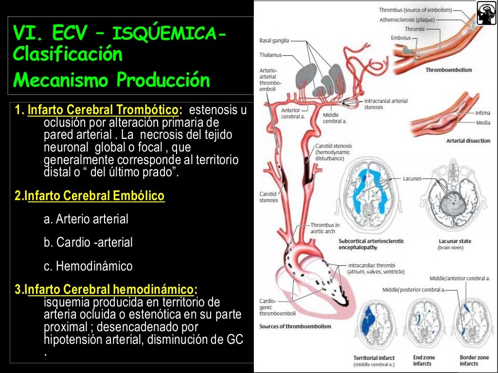 enfermedad cerebro vascular isquemica