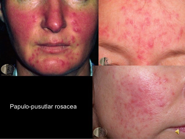 8. acne and rosacea