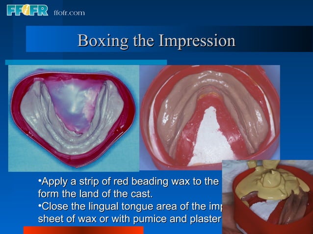 8.boxing impressions and making casts | PPT | Oral care | Personal Care