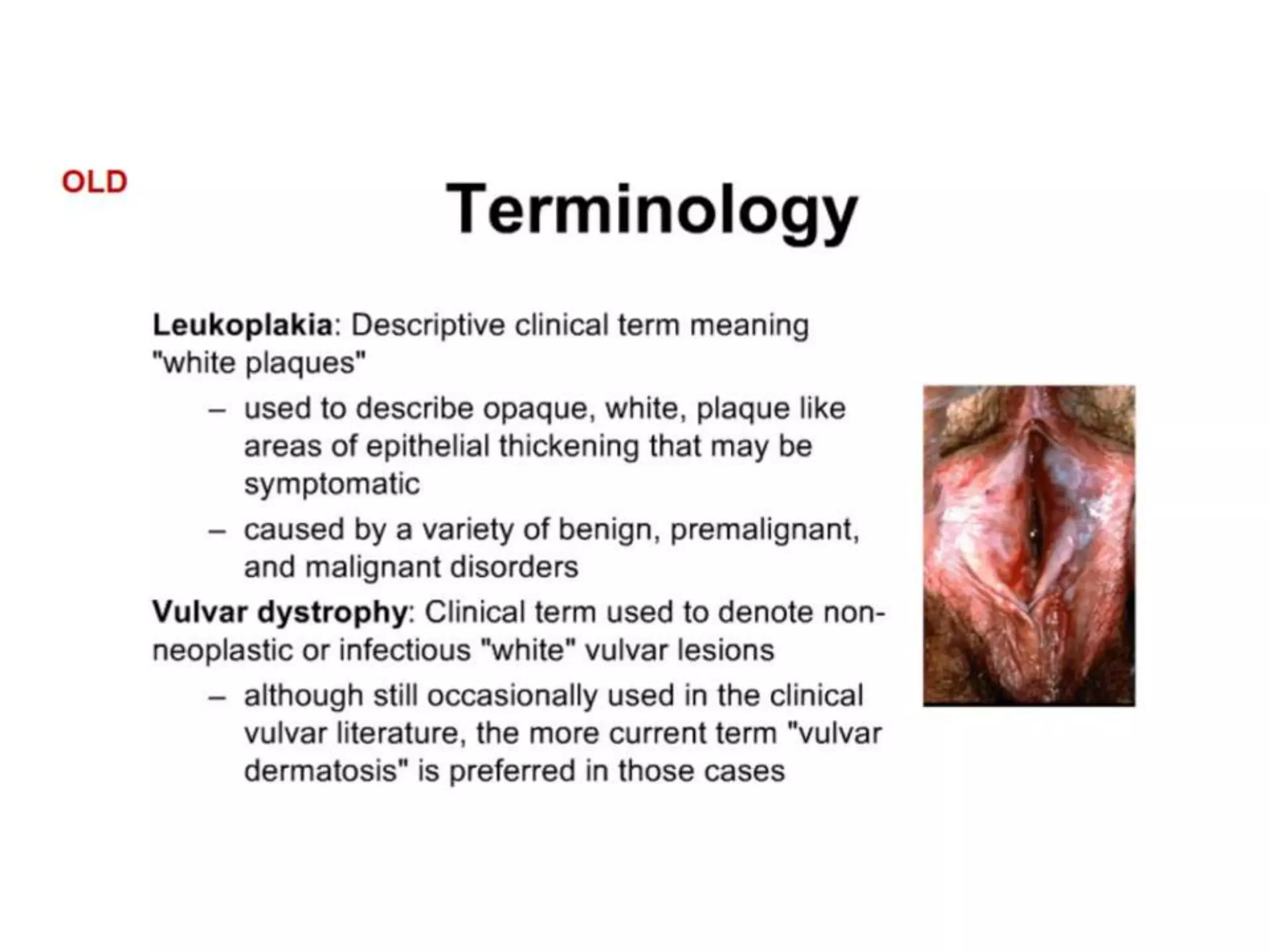 8 Lesions of vulva and vagina 19-3-2018 | PPT