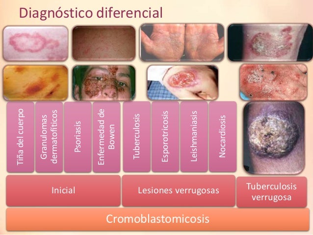 8.cromoblastomicosis