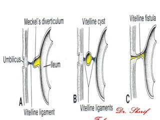 Vitelline Fistula