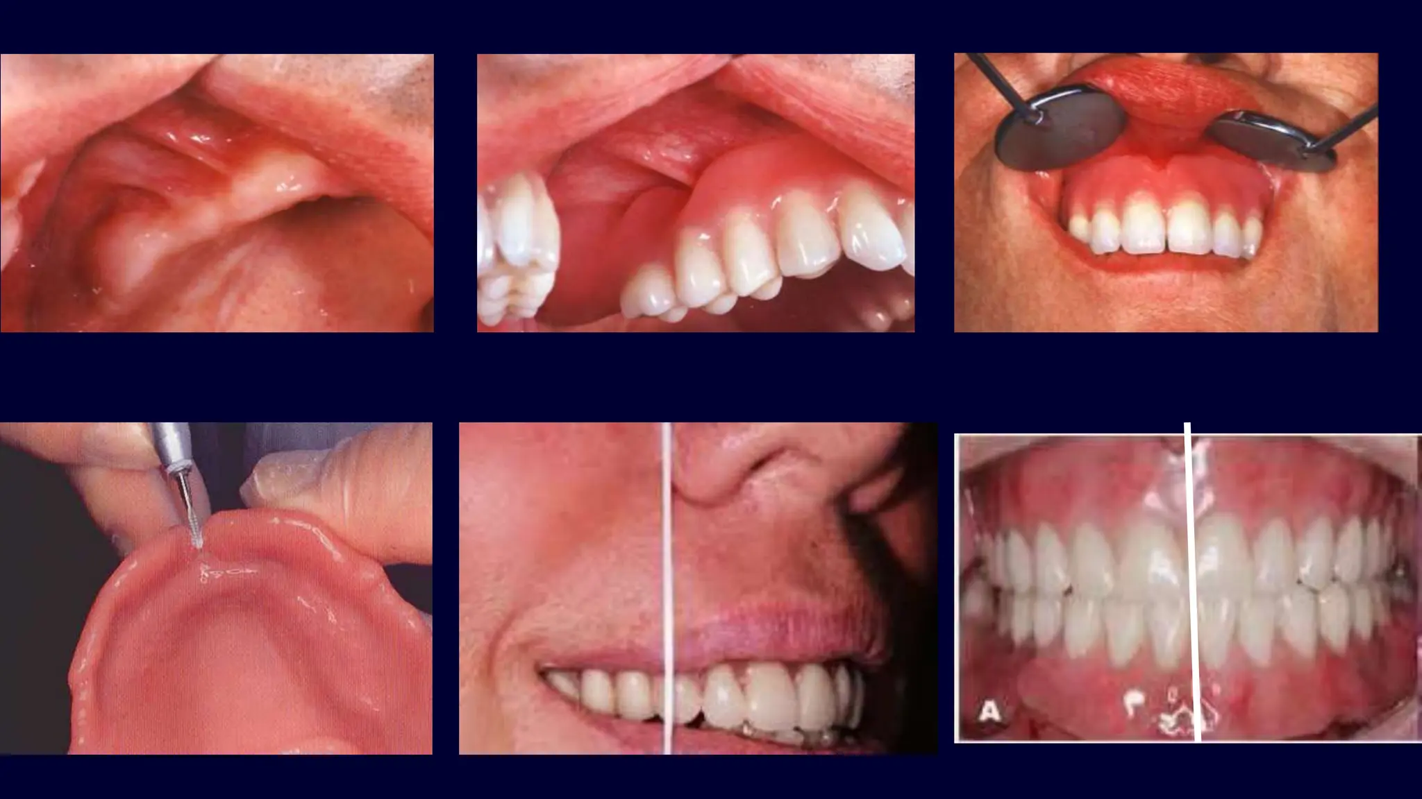 8- Complete denture insertion (Delivery).pptx