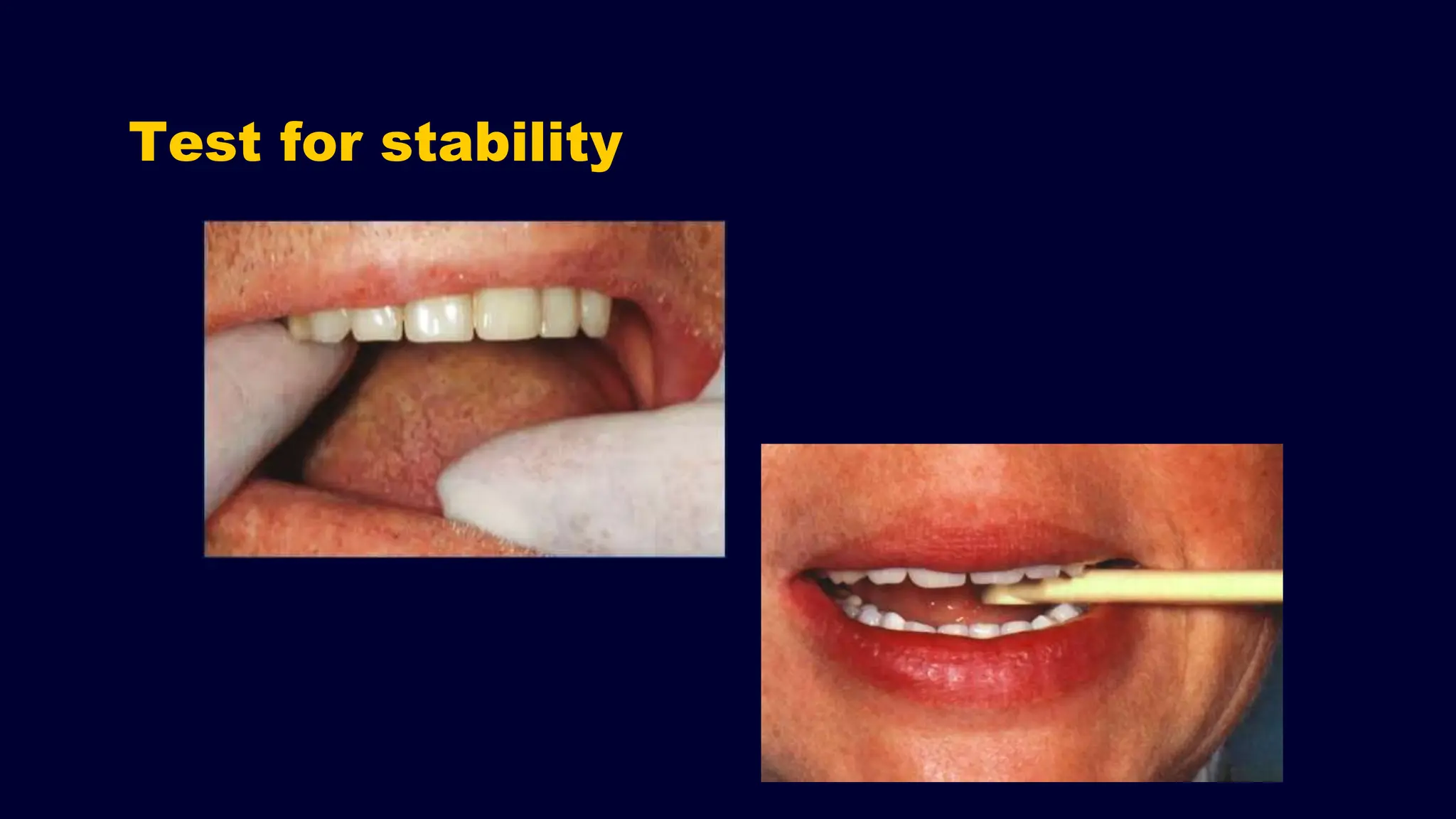 8- Complete denture insertion (Delivery).pptx