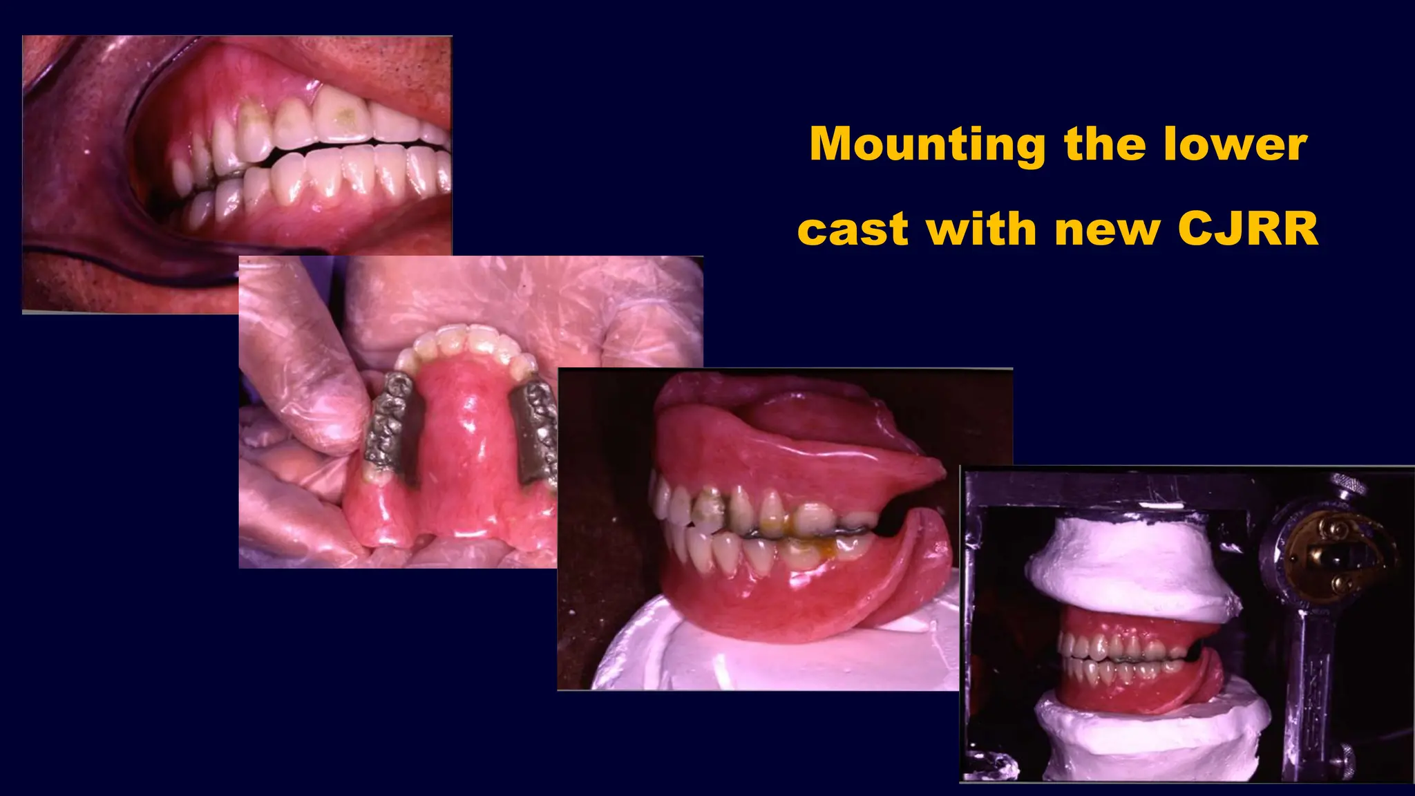 8- Complete denture insertion (Delivery).pptx