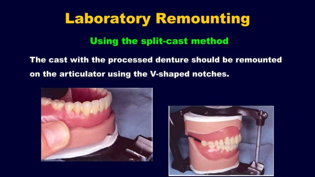 8- Complete denture insertion (Delivery).pptx