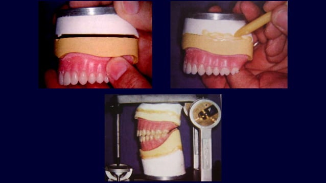 8- Complete denture insertion (Delivery).pptx