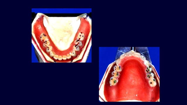 8- Complete denture insertion (Delivery).pptx