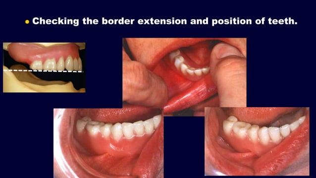 8- Complete denture insertion (Delivery).pptx