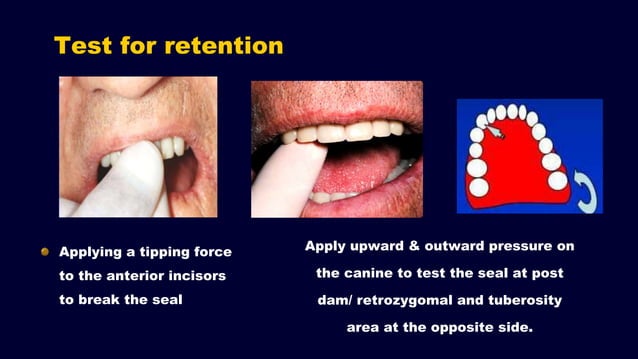8- Complete denture insertion (Delivery).pptx
