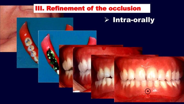 8- Complete denture insertion (Delivery).pptx