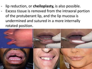 Lecture 3 facial cosmetic surgery | PPTX