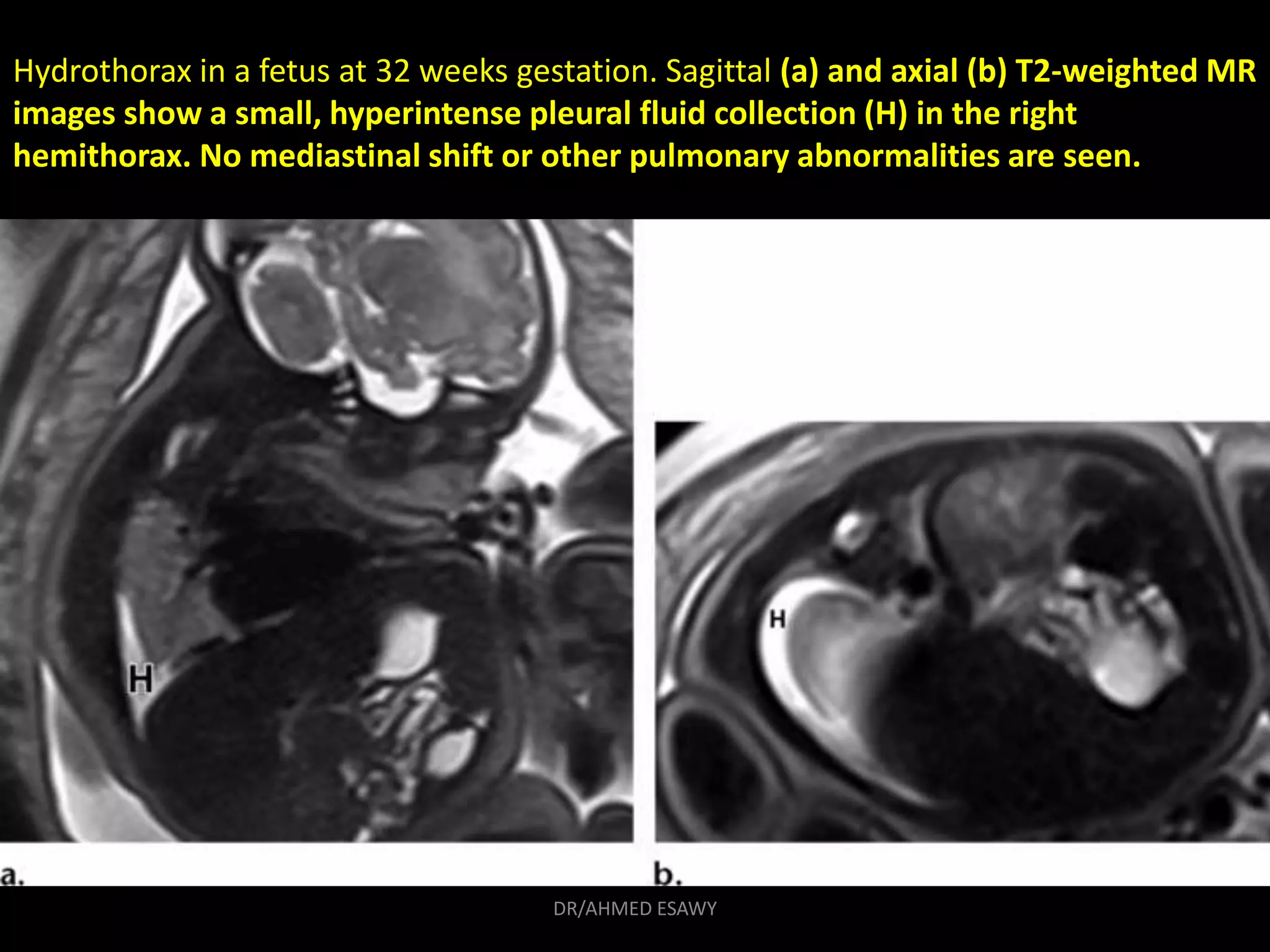 8 fetal chest Dr Ahmed Esawy | PDF