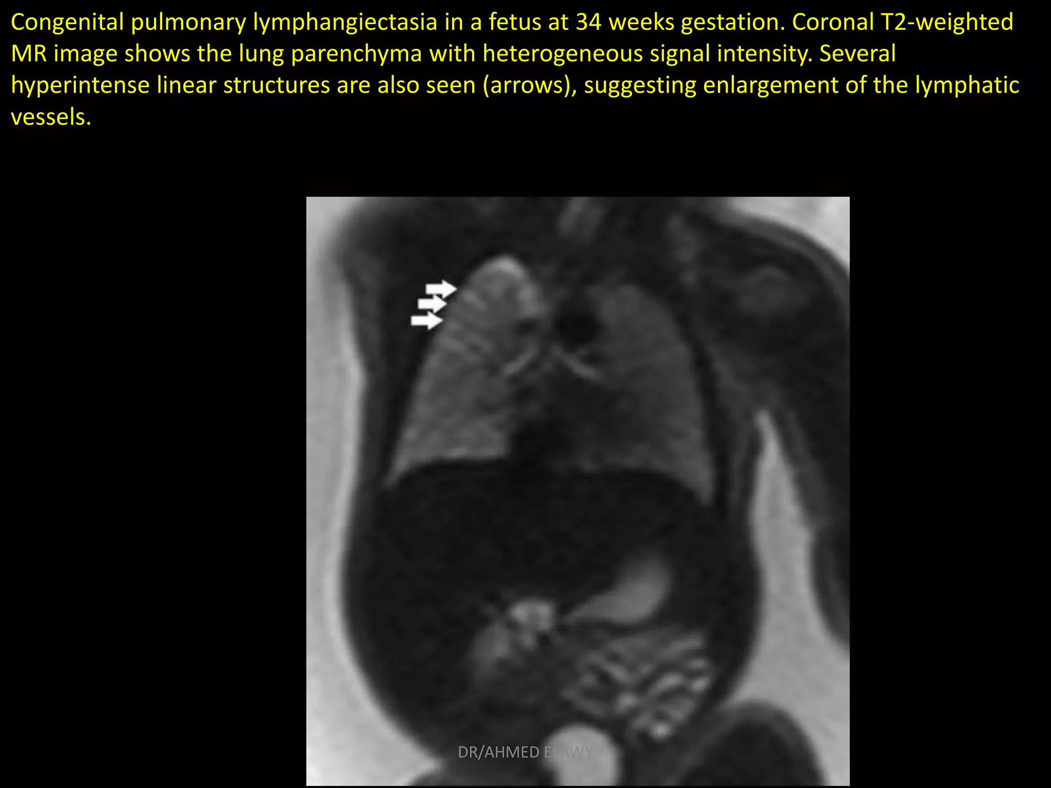 8 fetal chest Dr Ahmed Esawy | PDF