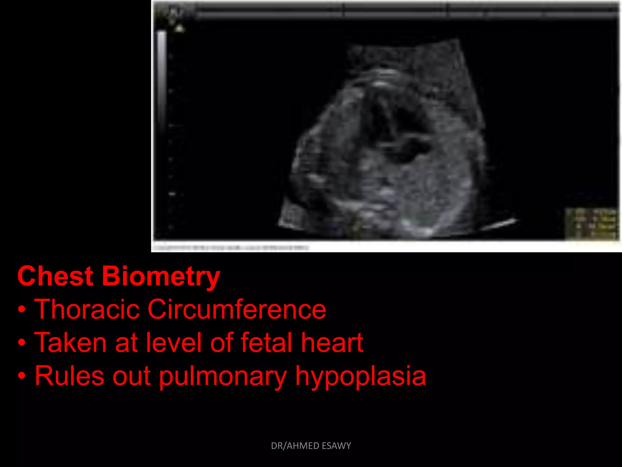 8 fetal chest Dr Ahmed Esawy | PPT