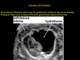 Pleural Effusion Fetal Ultrasound