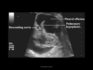 Fetal Pleural Effusion Ultrasound
