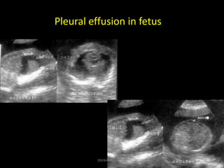 Pleural Effusion Fetal Ultrasound
