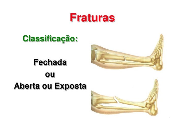 fraturas, entorces e luxações