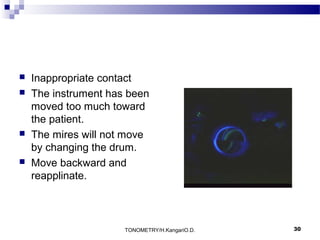 Goldman applanation tonometry | PPT