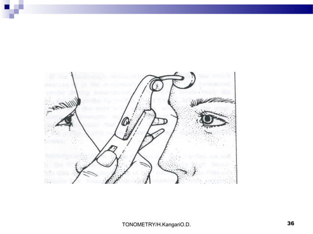 Goldman applanation tonometry | PPT