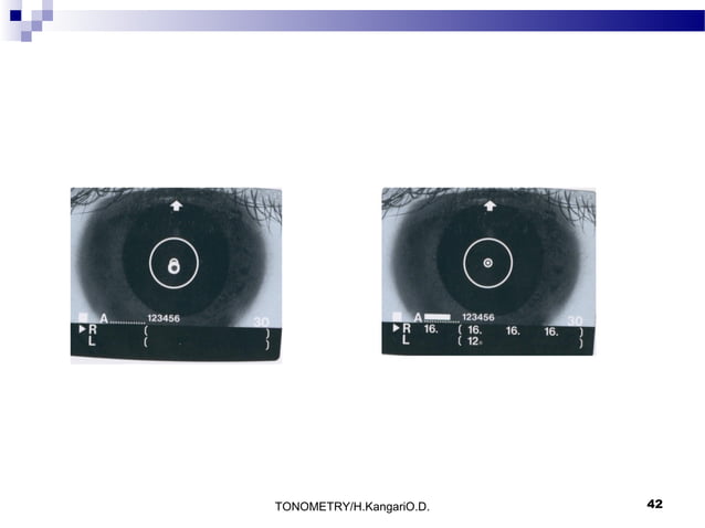 Goldman applanation tonometry | PPT