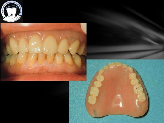 IMMEDIATE DENTURE | PPTX | Oral care | Personal Care