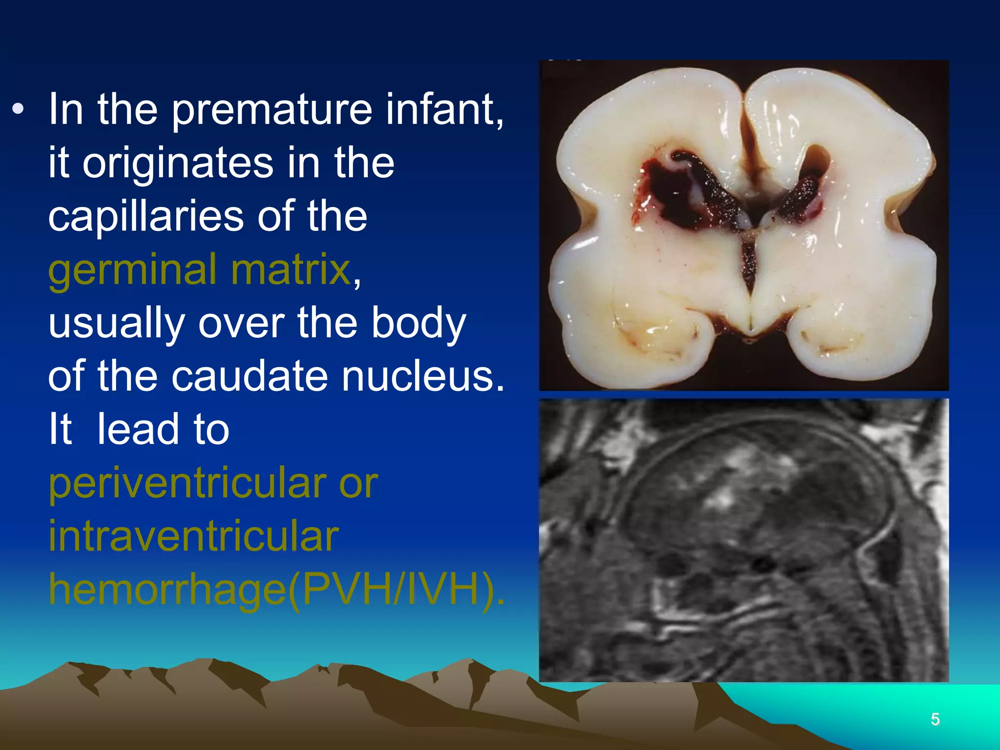8--Intracranial Hemorrhage of the Newborn{8}.ppt