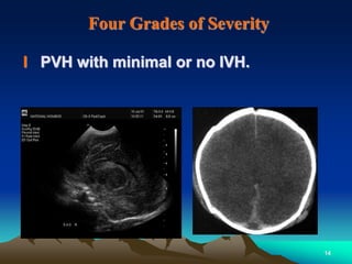 8--Intracranial Hemorrhage of the Newborn{8}.ppt