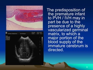 8--Intracranial Hemorrhage of the Newborn{8}.ppt