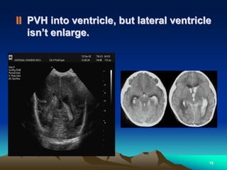 8--Intracranial Hemorrhage of the Newborn{8}.ppt