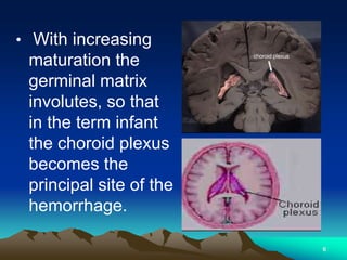 8--Intracranial Hemorrhage of the Newborn{8}.ppt