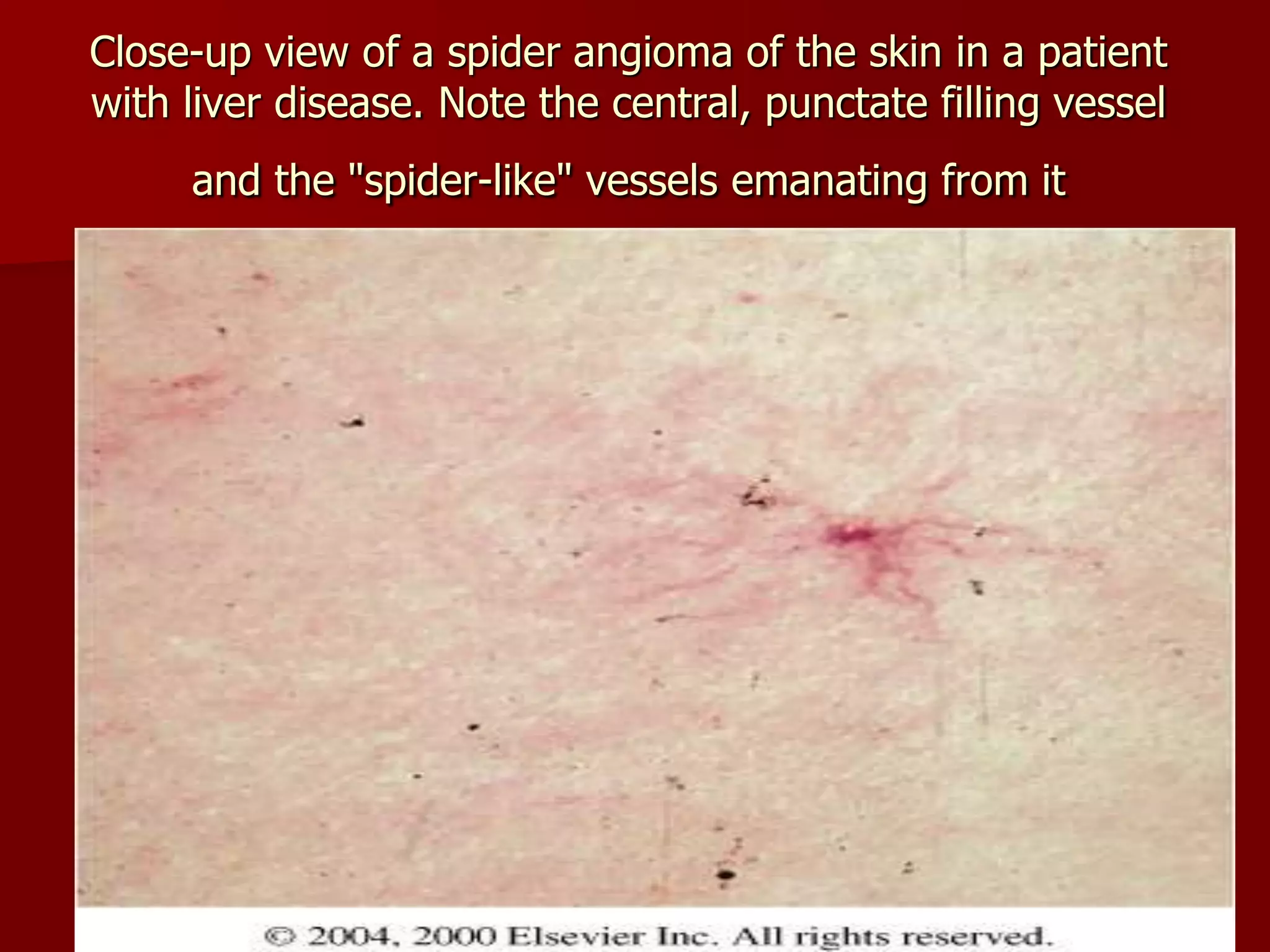 jaundice - yellow discoloration of tissue. | PPT | Blood Disorders ...