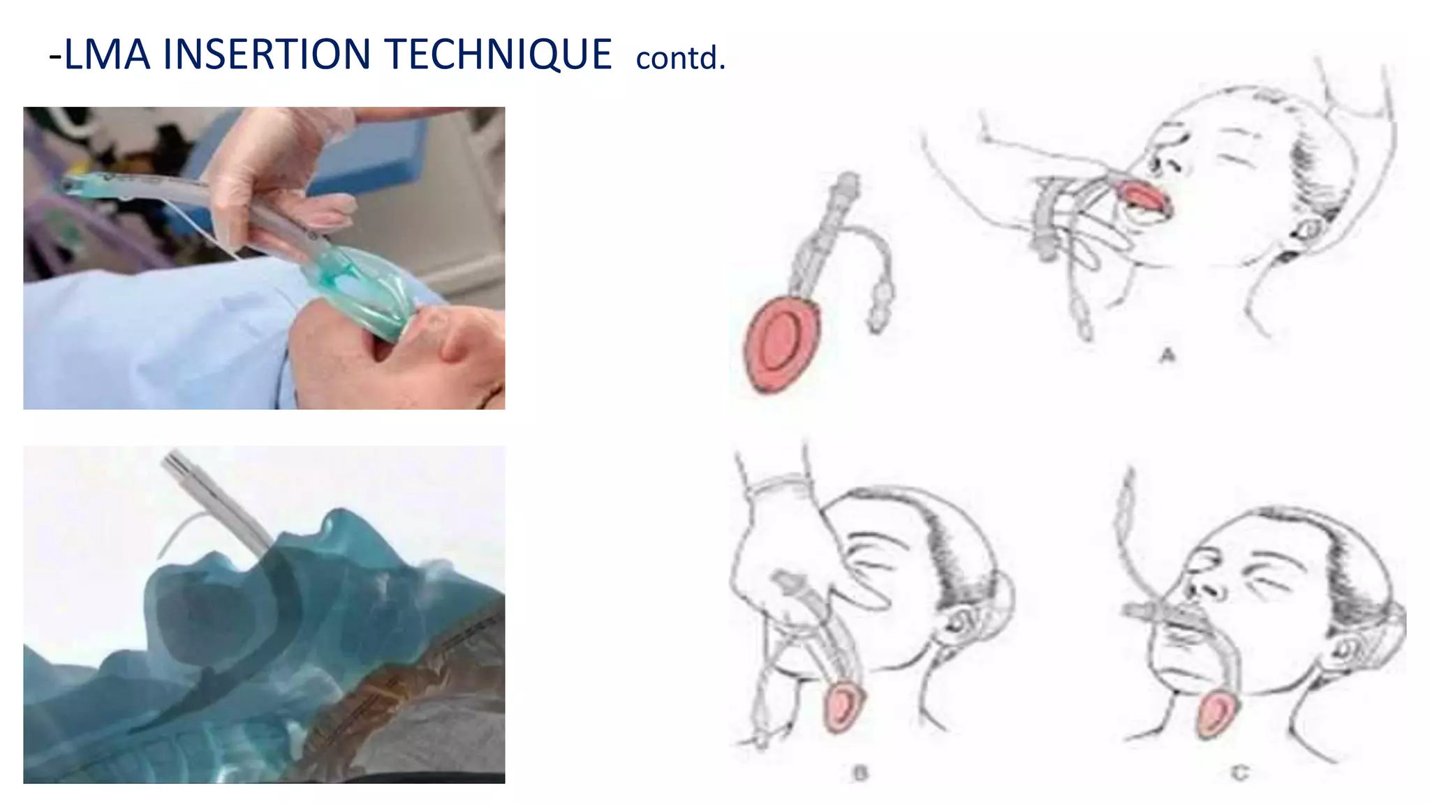 airway management -Anesthesia | PDF