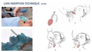airway management -Anesthesia | PDF
