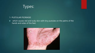 8- Psoriasis.pptx