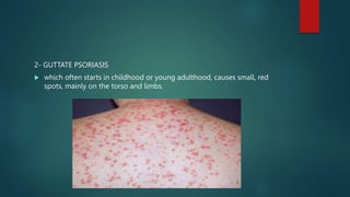 8- Psoriasis.pptx