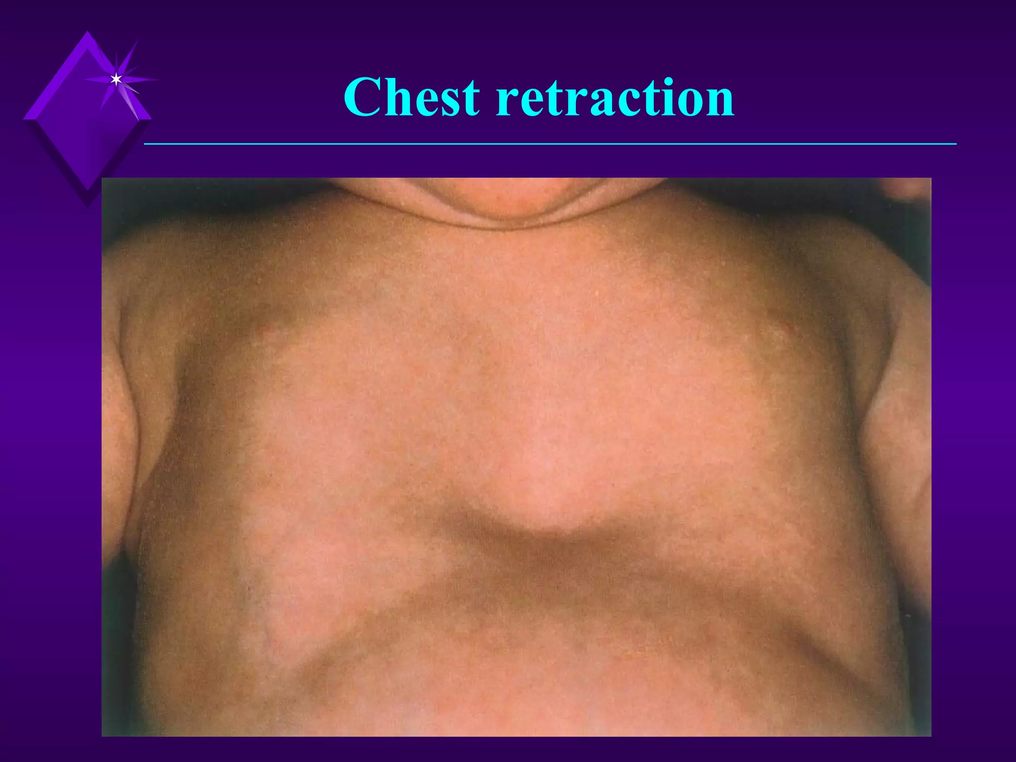 Respiratory Distress Syndrome (Rds) | PPT