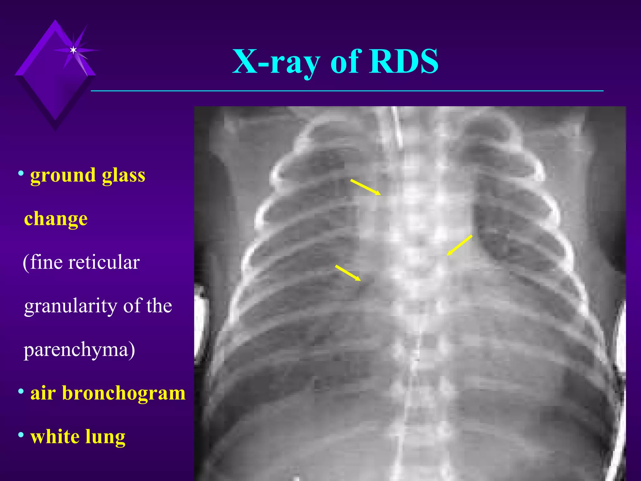 Respiratory Distress Syndrome (Rds) | PPT