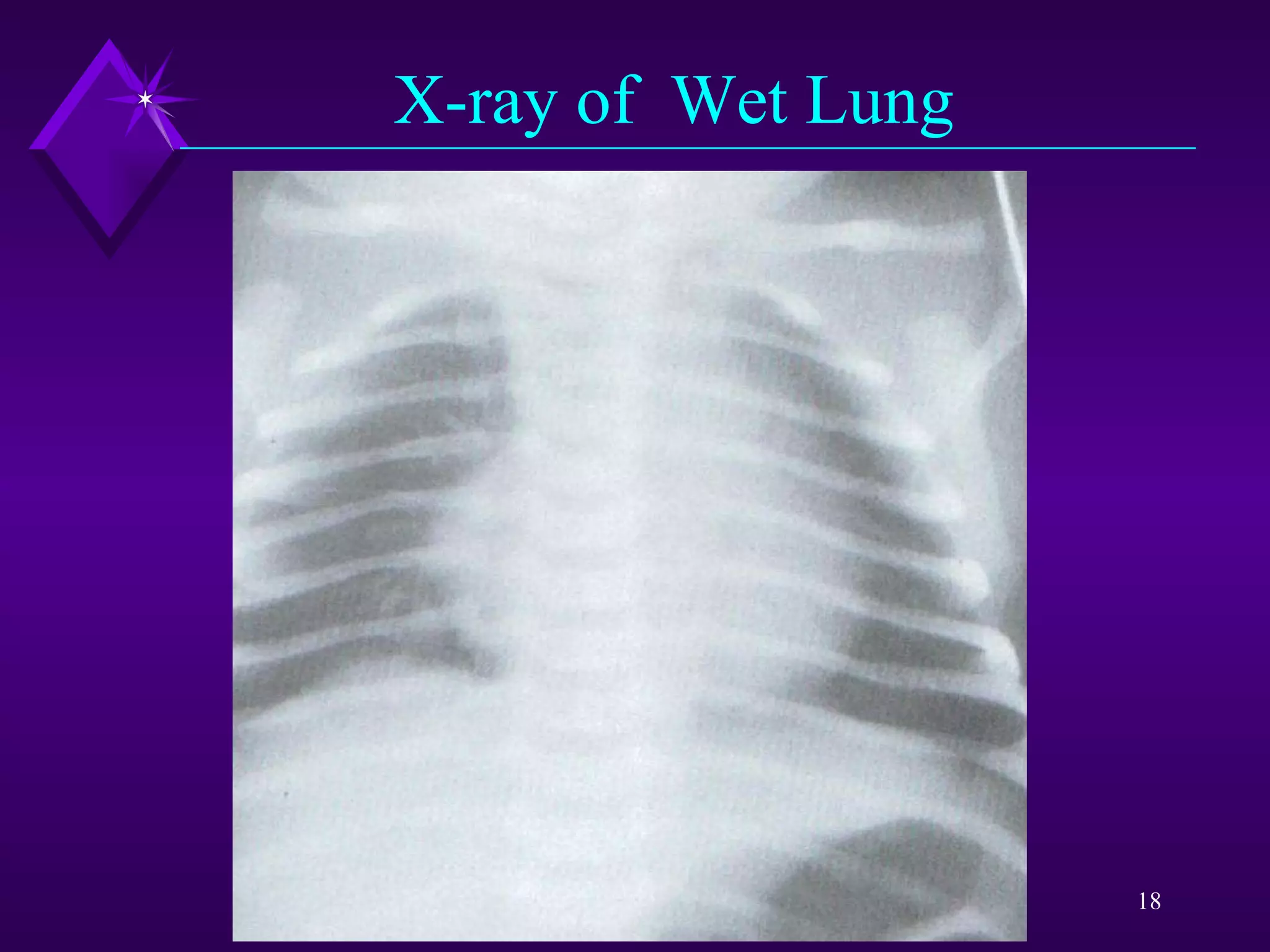 Respiratory Distress Syndrome (Rds) | PPT