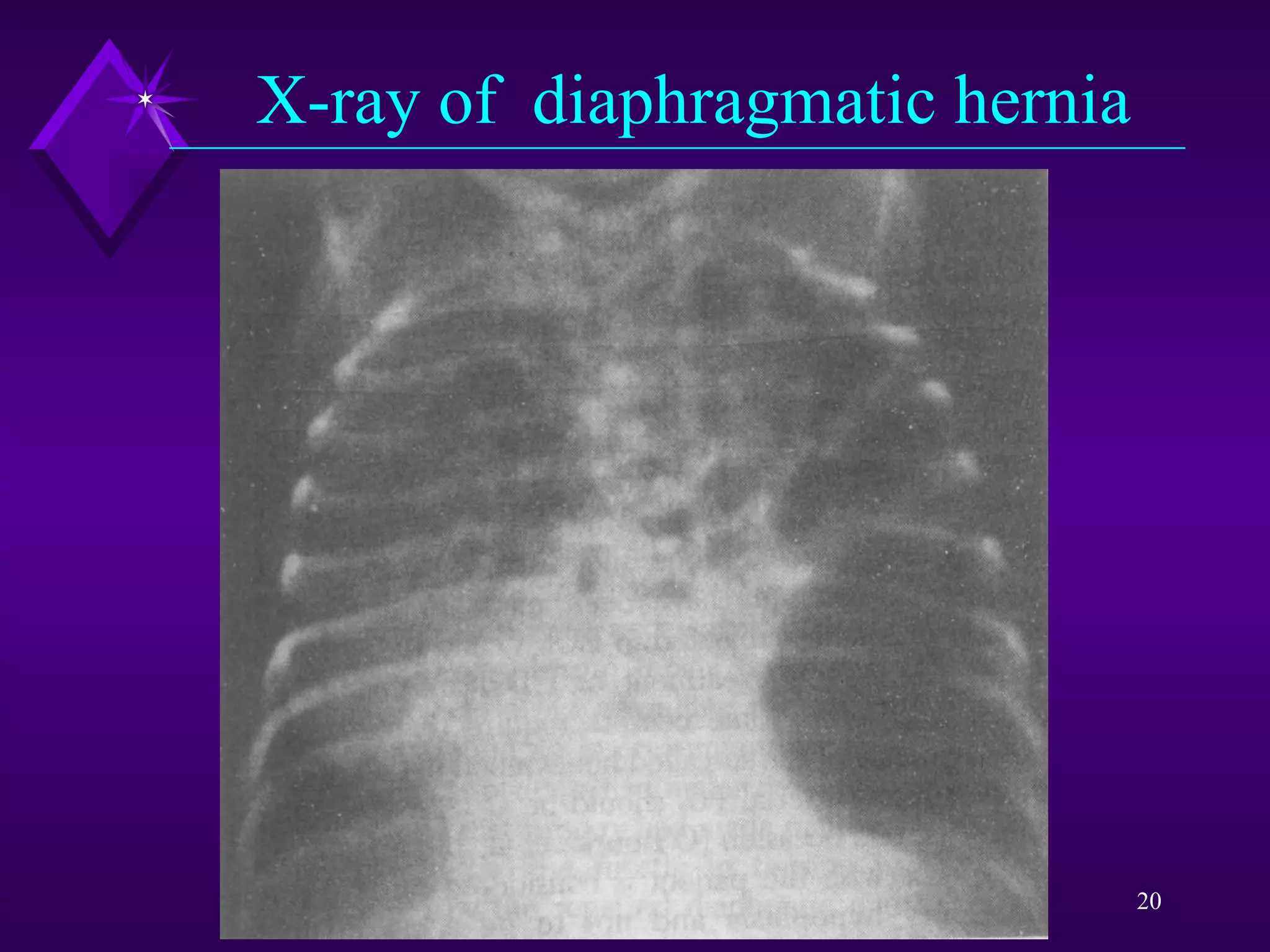 Respiratory Distress Syndrome (Rds) | PPT