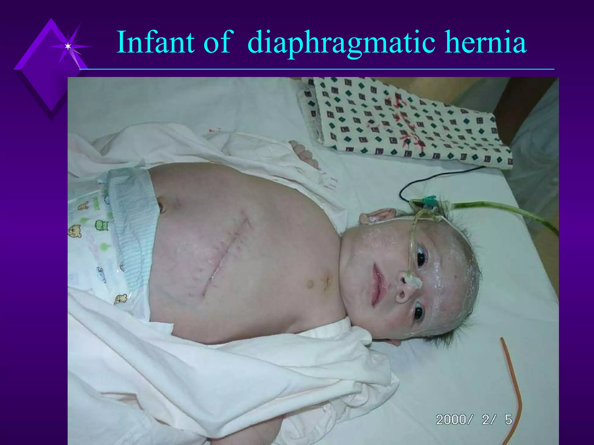 Respiratory Distress Syndrome (Rds) | PPT
