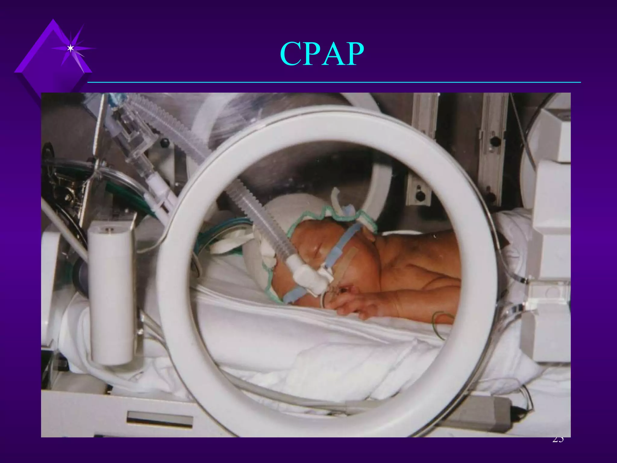 Respiratory Distress Syndrome (Rds) | PPT
