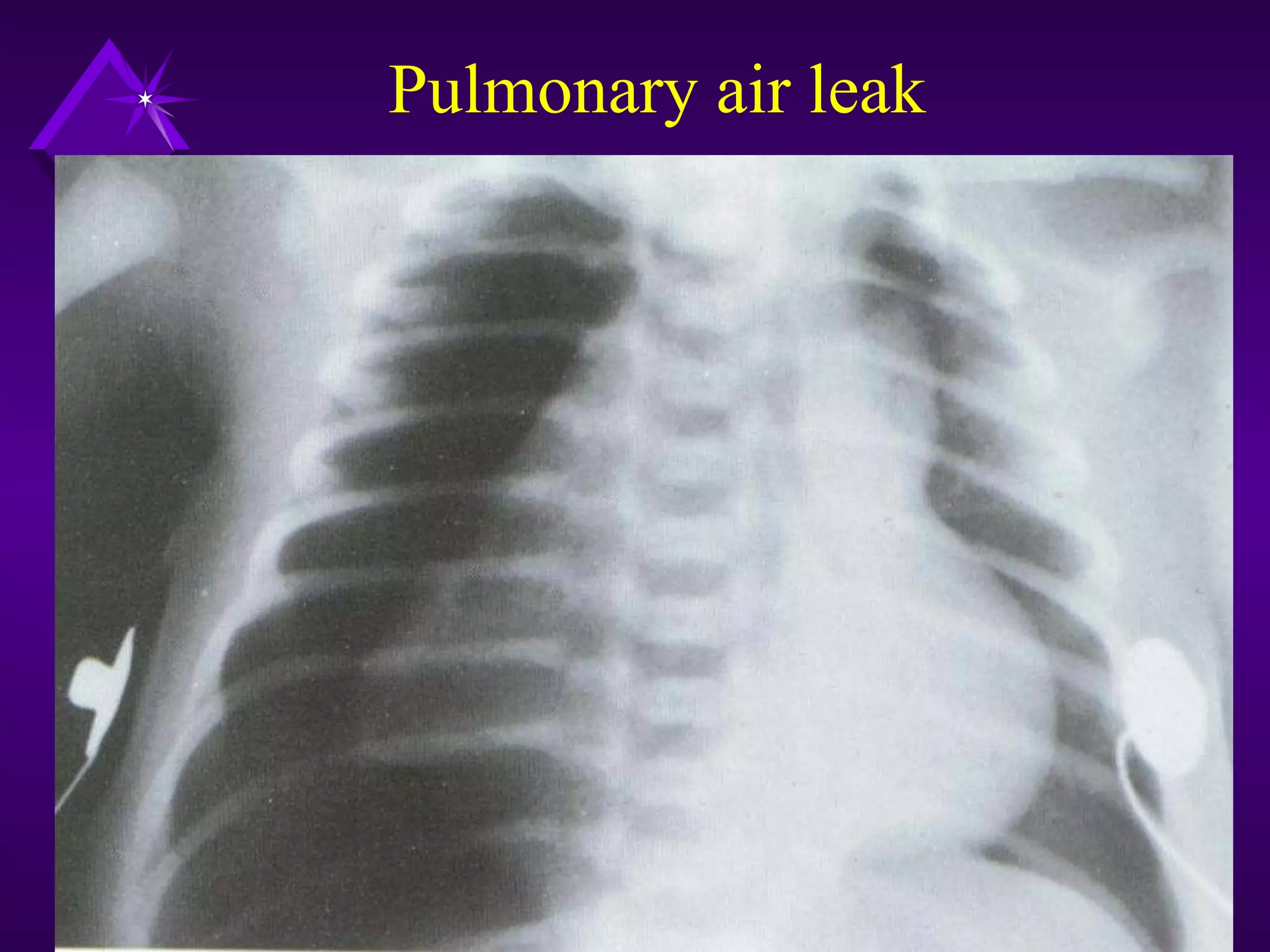 Respiratory Distress Syndrome (Rds) | PPT