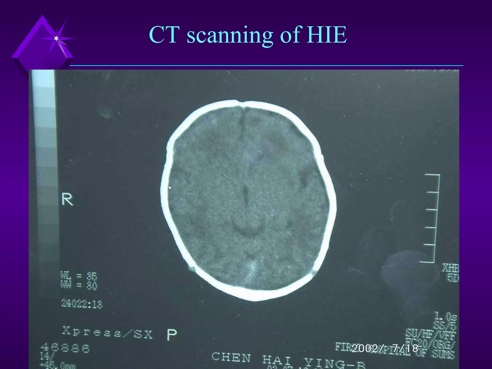 Respiratory Distress Syndrome (Rds) | PPT