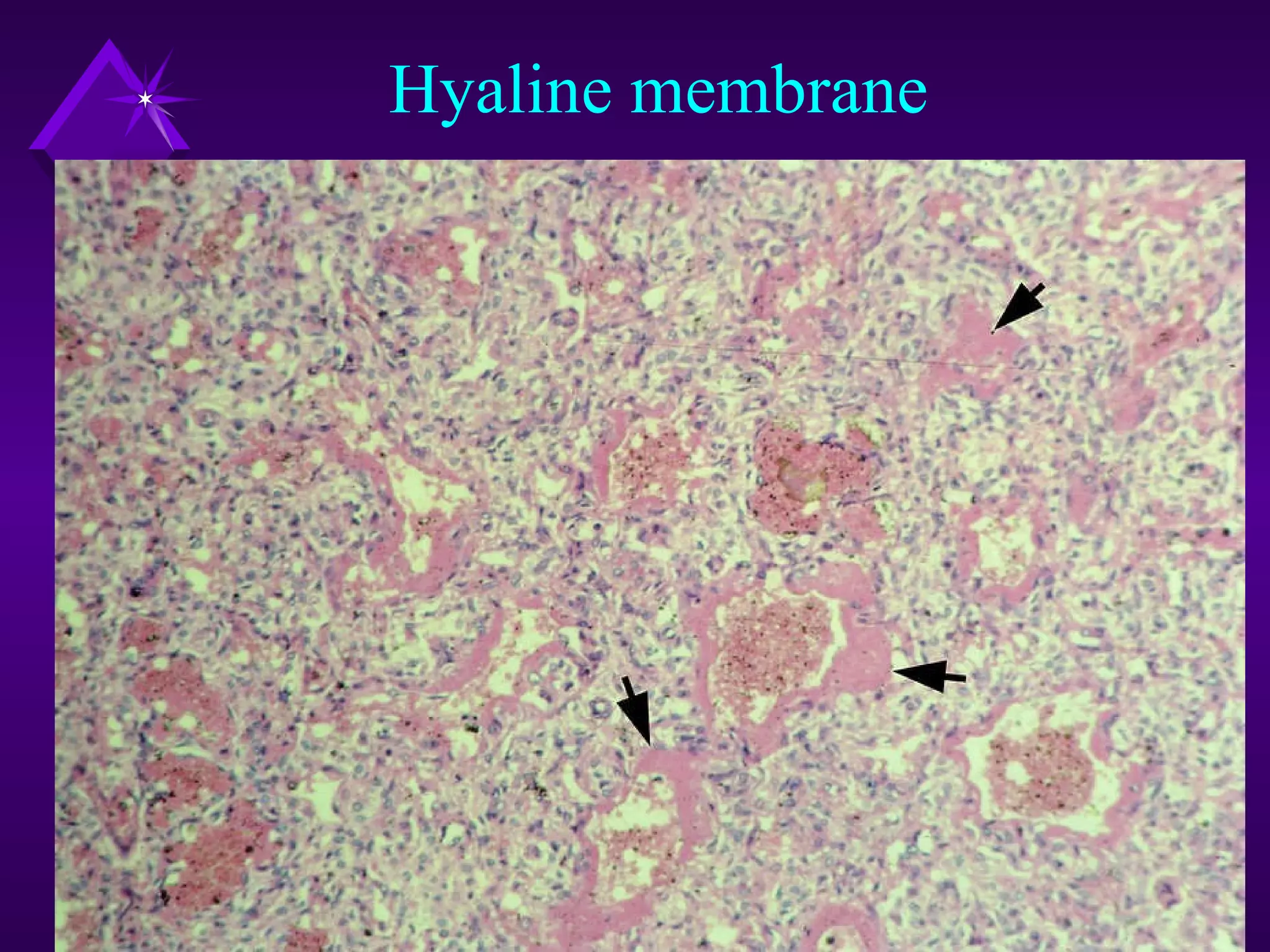 Respiratory Distress Syndrome (Rds) | PPT