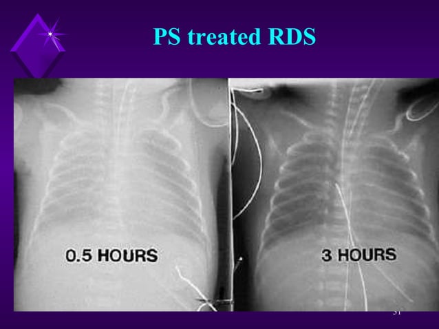 Respiratory Distress Syndrome (Rds) | PPT
