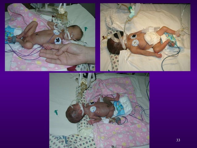 Respiratory Distress Syndrome (Rds) | PPT