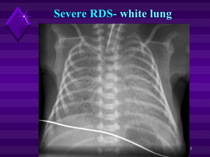 Respiratory Distress Syndrome (Rds)