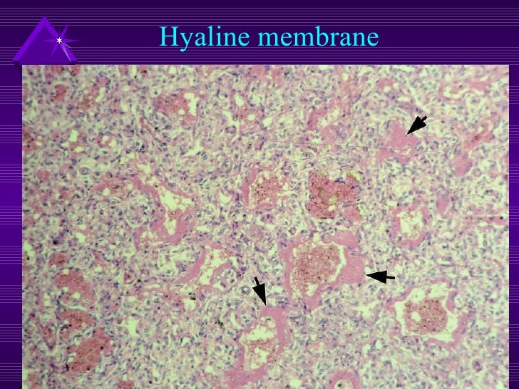 Respiratory Distress Syndrome (Rds)